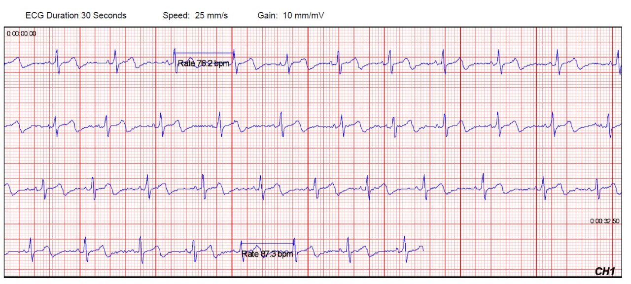 About Electrocardiograms (EKG/ECG) - CardioComm Solutions